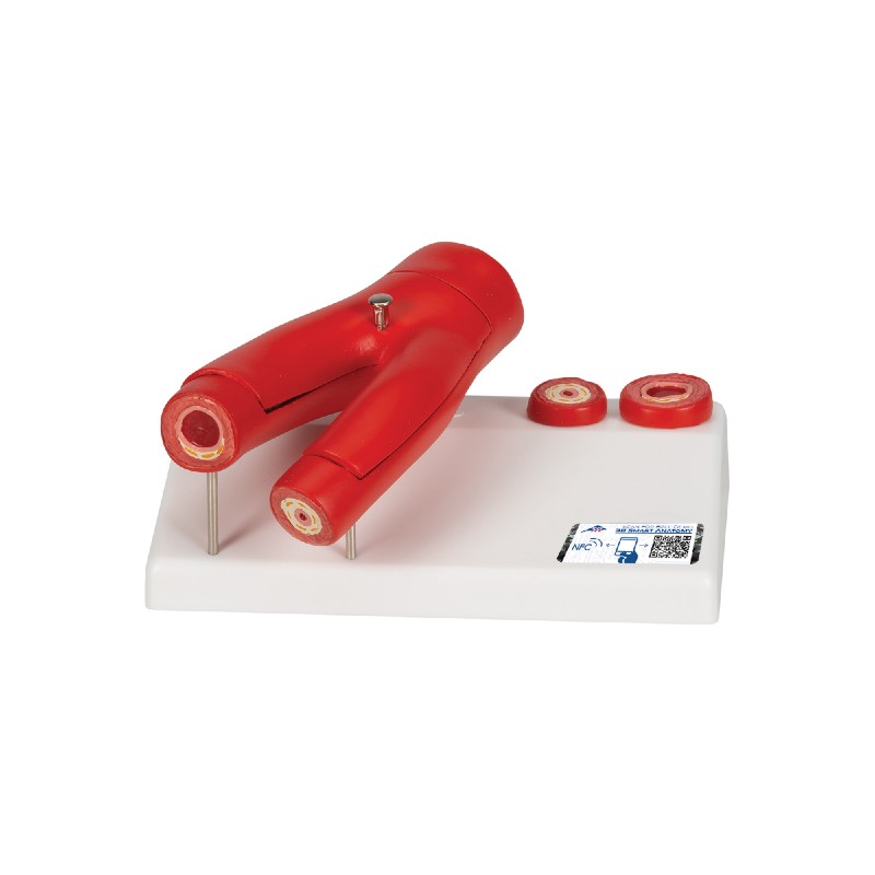 2-Part Atherosclerosis Model w/ Artery | Health and Care